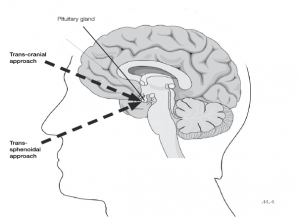 Pituitary Surgery | Hull University Teaching Hospitals NHS Trust