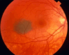 Choroidal Naevus (Freckle) | Hull University Teaching Hospitals NHS Trust