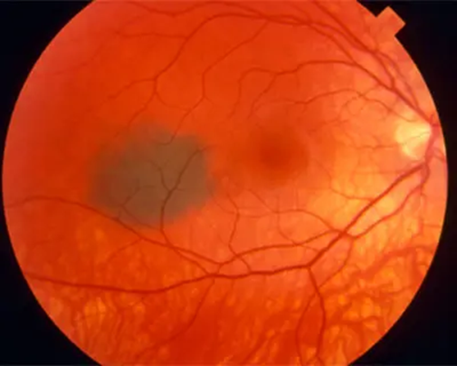 Choroidal Naevus (Freckle) | Hull University Teaching Hospitals NHS Trust