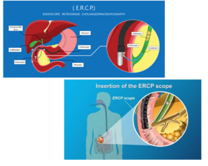Endoscopic Retrograde Cholangiopancreatography (ERCP) | Hull University ...