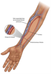 Formation of Fistula for Haemodialysis | Hull University Teaching ...