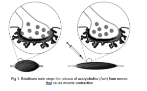 Treatment with Botulinum Toxin | Hull University Teaching Hospitals NHS ...