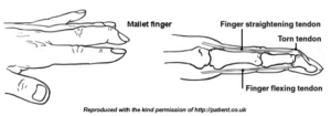 Mallet Finger – Symptoms and Management | Hull University Teaching ...