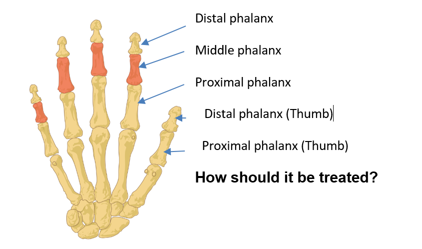 Hand Therapy - Phalangeal fractures of the fingers or thumb | Hull University Teaching Hospitals ...