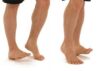 Patella dislocation - Advice regarding healing and recovery | Hull ...