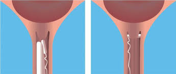 Information about Induction of Labour | Hull University Teaching ...