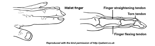 Hand Therapy - Mallet Injury of the Finger (PIFU) | Hull University Teaching Hospitals NHS Trust