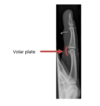 Hand Therapy - Volar Plate Injury of the Finger (PIFU) | Hull ...