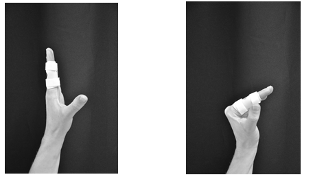 Closed Central Slip Injury (Boutonniere Deformity) - Advice to patients ...