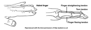 Mallet Injury of the Finger - Patient Initiated Follow-up (PIFU) | Hull ...