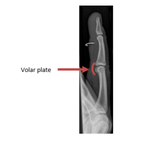 Volar Plate Injury of the Finger - Patient Initiated Follow-up (PIFU ...