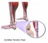 Achilles Tendon Rupture - Information for Patients | Hull University ...