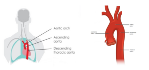 Understanding Thoracic Aortic Aneurysm | Hull University Teaching ...