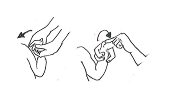 Obstetric Brachial Plexus Injury (ERB’s Palsy) | Hull University ...