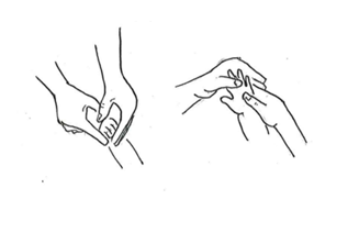 Obstetric Brachial Plexus Injury (ERB’s Palsy) | Hull University ...