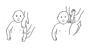 Obstetric Brachial Plexus Injury (ERB’s Palsy) | Hull University ...