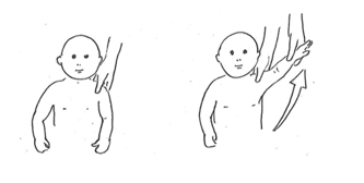 Obstetric Brachial Plexus Injury (ERB’s Palsy) | Hull University ...