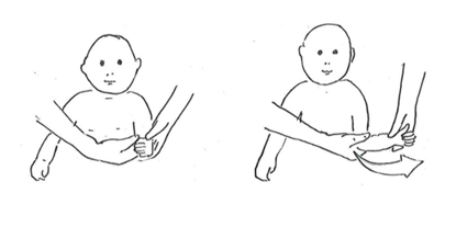 Obstetric Brachial Plexus Injury (ERB’s Palsy) | Hull University ...