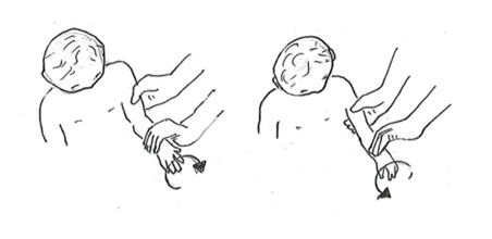 Obstetric Brachial Plexus Injury (ERB’s Palsy) | Hull University ...