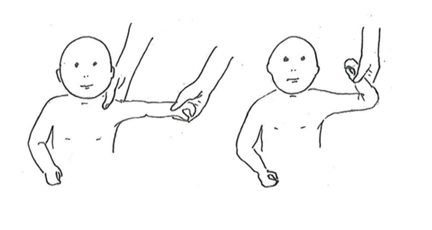 Obstetric Brachial Plexus Injury (ERB’s Palsy) | Hull University ...