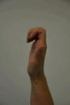 Hand Therapy - Volar Plate Injury of the Finger (PIFU) | Hull ...