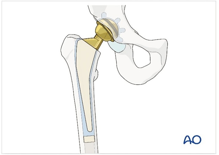 Care of your hip following surgery (not total hip replacement) | Hull ...