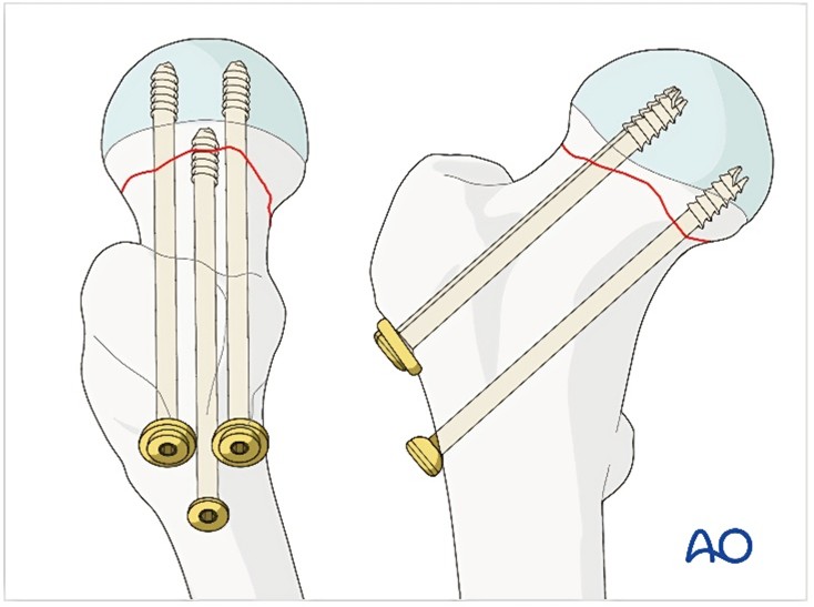 Care of your hip following surgery (not total hip replacement) | Hull ...