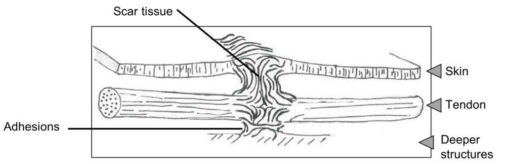 Scar Care: Information for Patient, Carers and Relatives | Hull ...